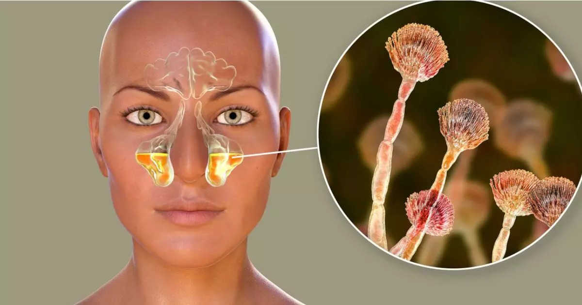 This infection of the nose is fatal, breaks the nerves and enters the ...