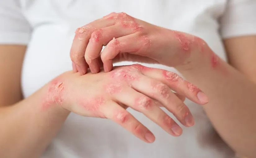 Monsoon Skin Care: Carelessness during the rainy season can cause red ...